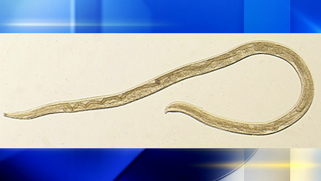 Woman has 14 wriggling worms pulled from her eye – WPXI