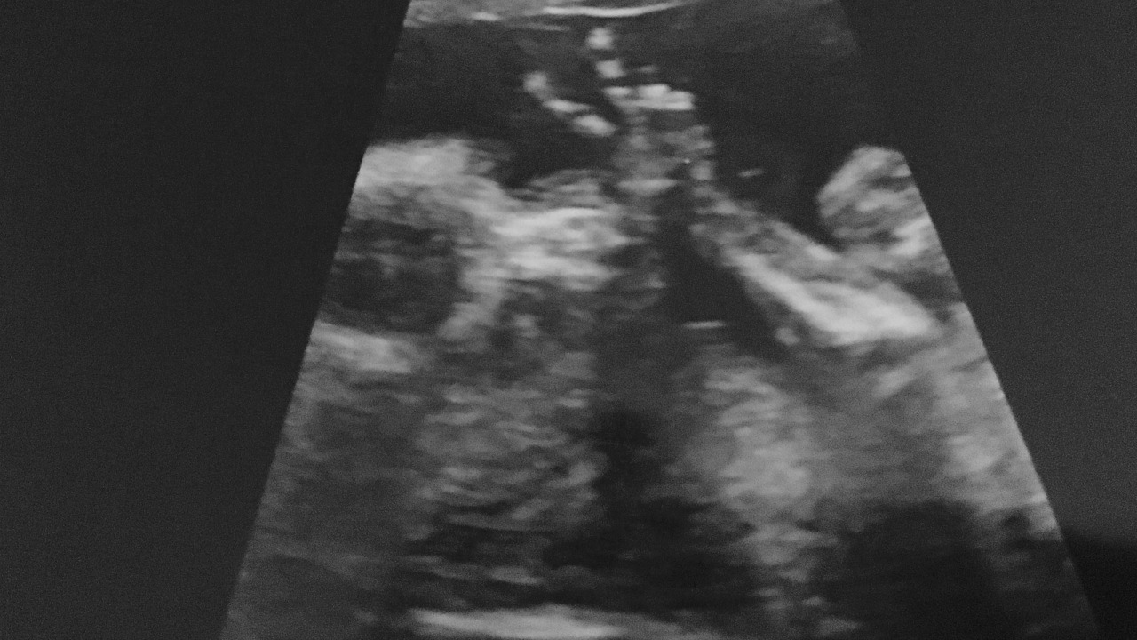 Baby flashes peace sign during ultrasound – Boston 25 News