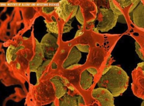 5 things you need to know about staph infections – WPXI