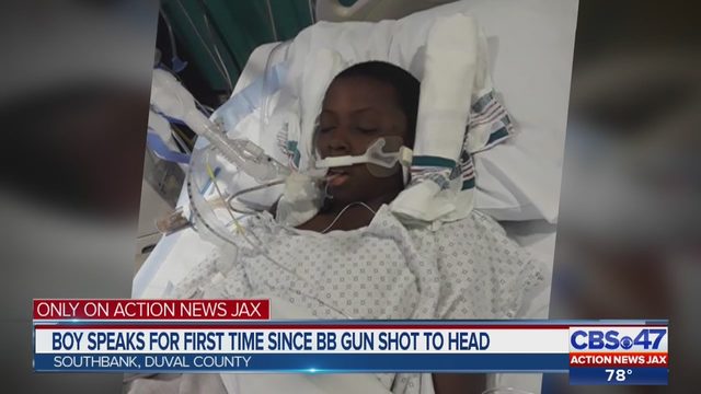 Boy shot in head with BB gun speaks, eats for first time since incident
